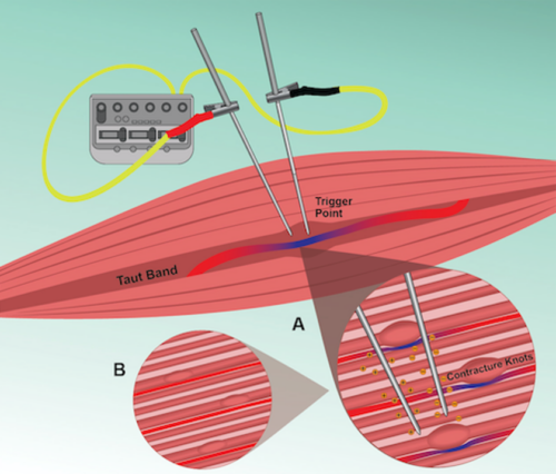 Intramuscular Electrical Stimulation - Myopain Seminars